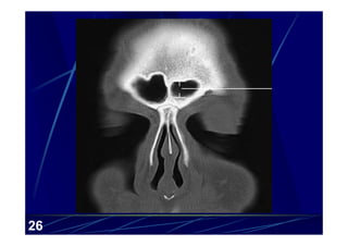 CT anatomy of the paranasal sinuses | PDF