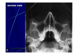 CT anatomy of the paranasal sinuses | PDF