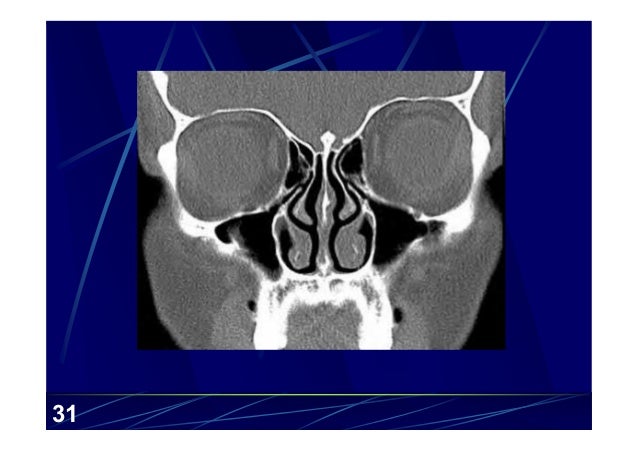 Ct Anatomy Of The Paranasal Sinuses Paranasal Sinus CT, Coronal