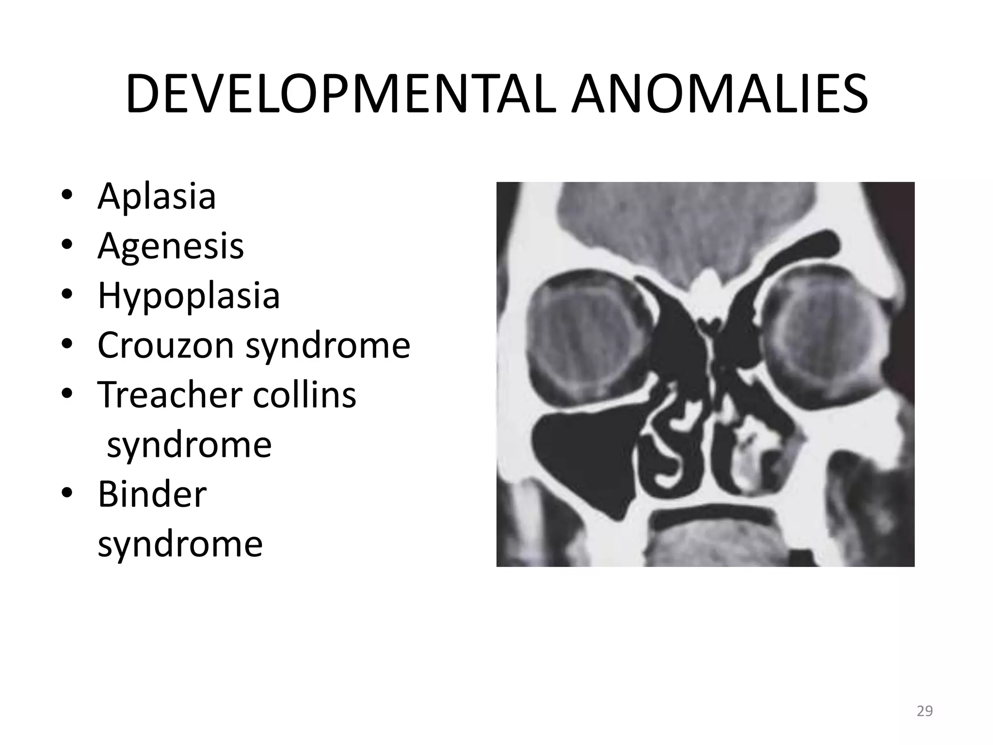 Paranasal air sinus | PPTX