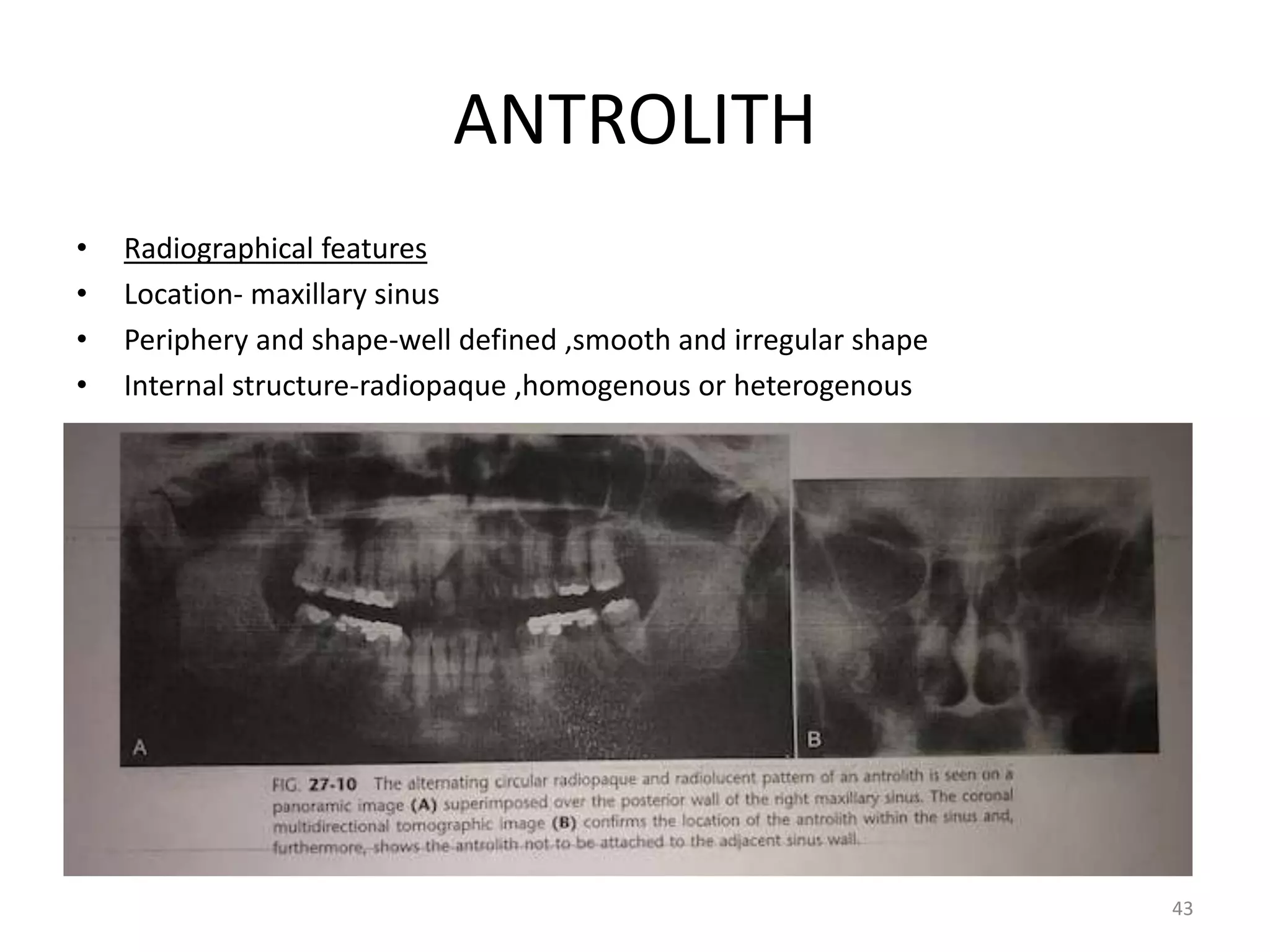 Paranasal air sinus | PPTX