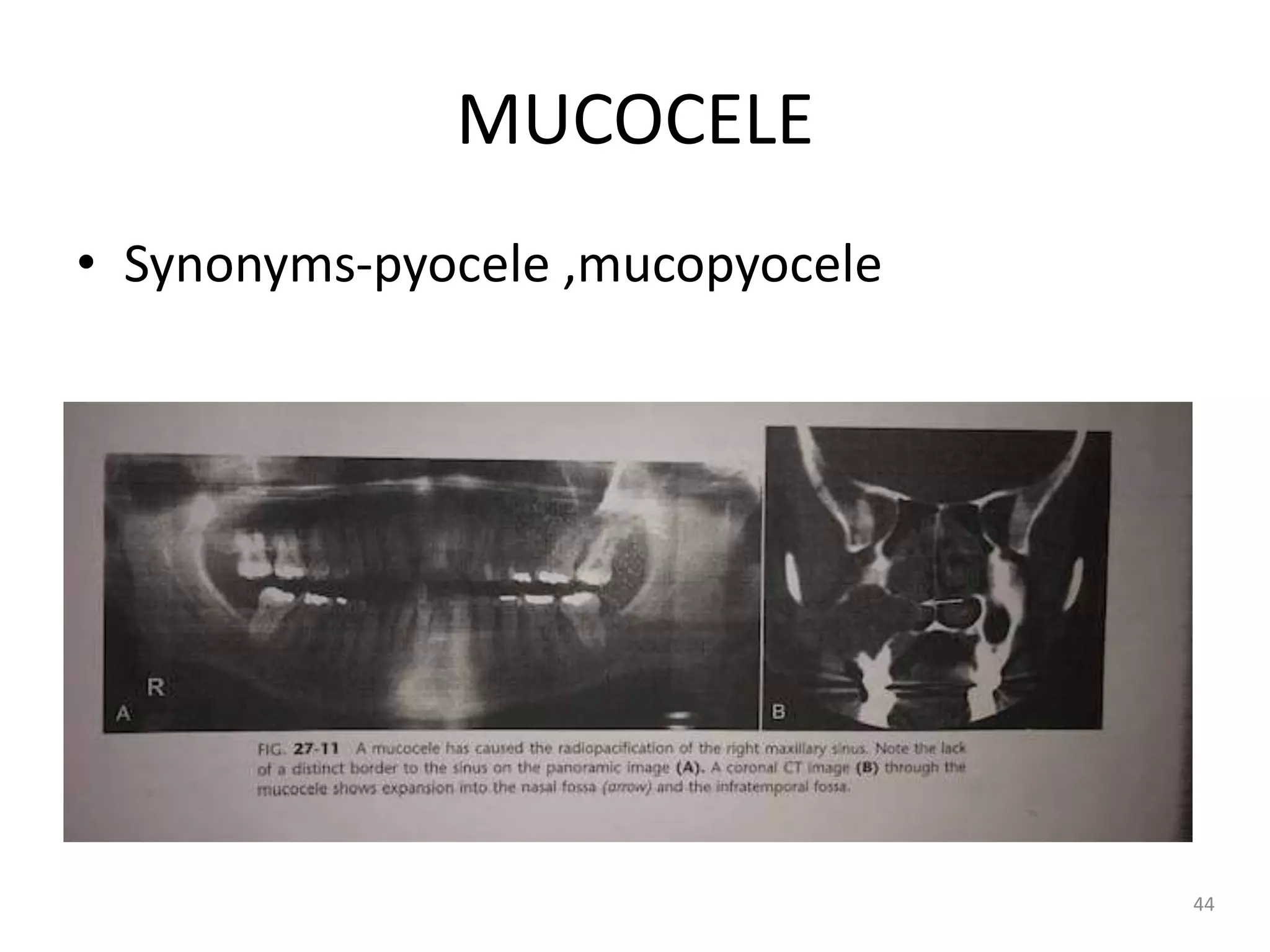 Paranasal air sinus | PPTX