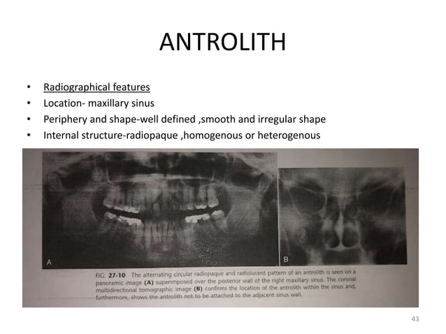 Paranasal air sinus | PPTX