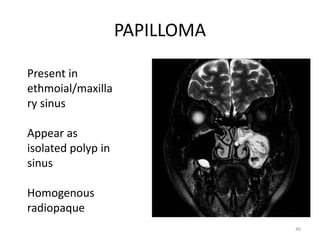 Paranasal air sinus | PPTX