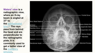 paranasal air sinus | PPTX