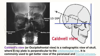 paranasal air sinus | PPTX | Ear, Nose and Throat Conditions | Diseases ...
