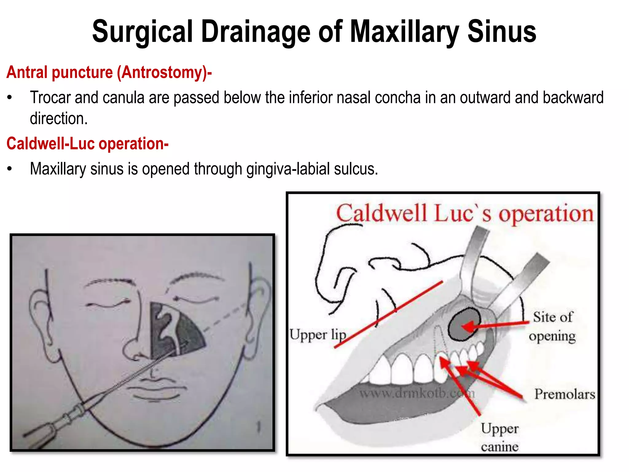 paranasal_air_sinuses.pptx