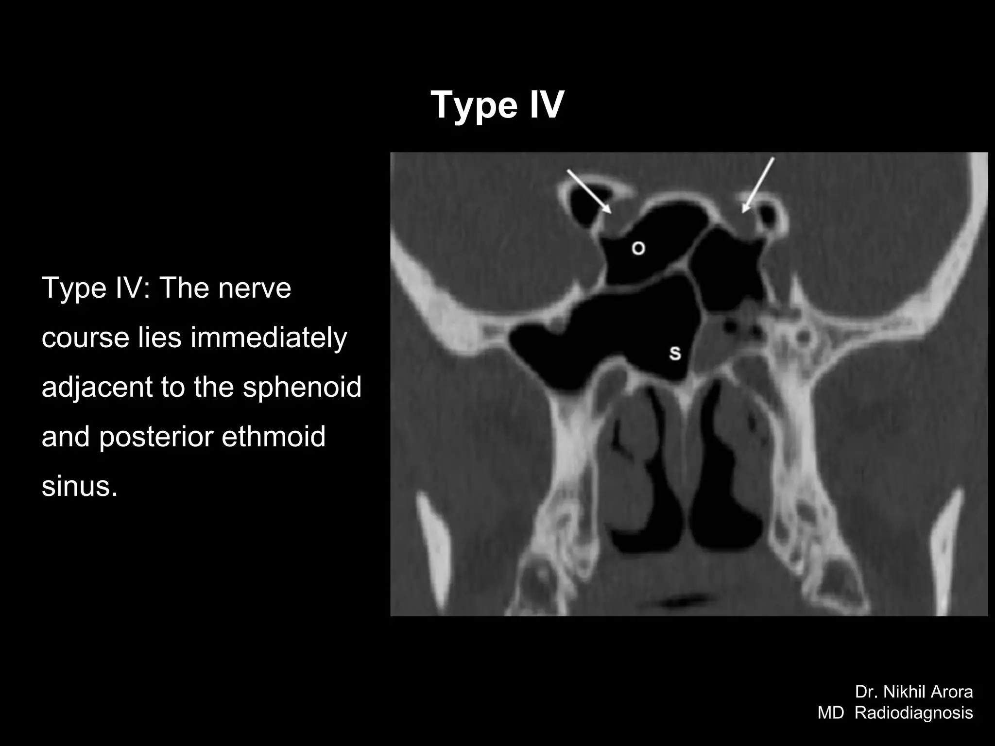 Paranasal sinuses .pptx