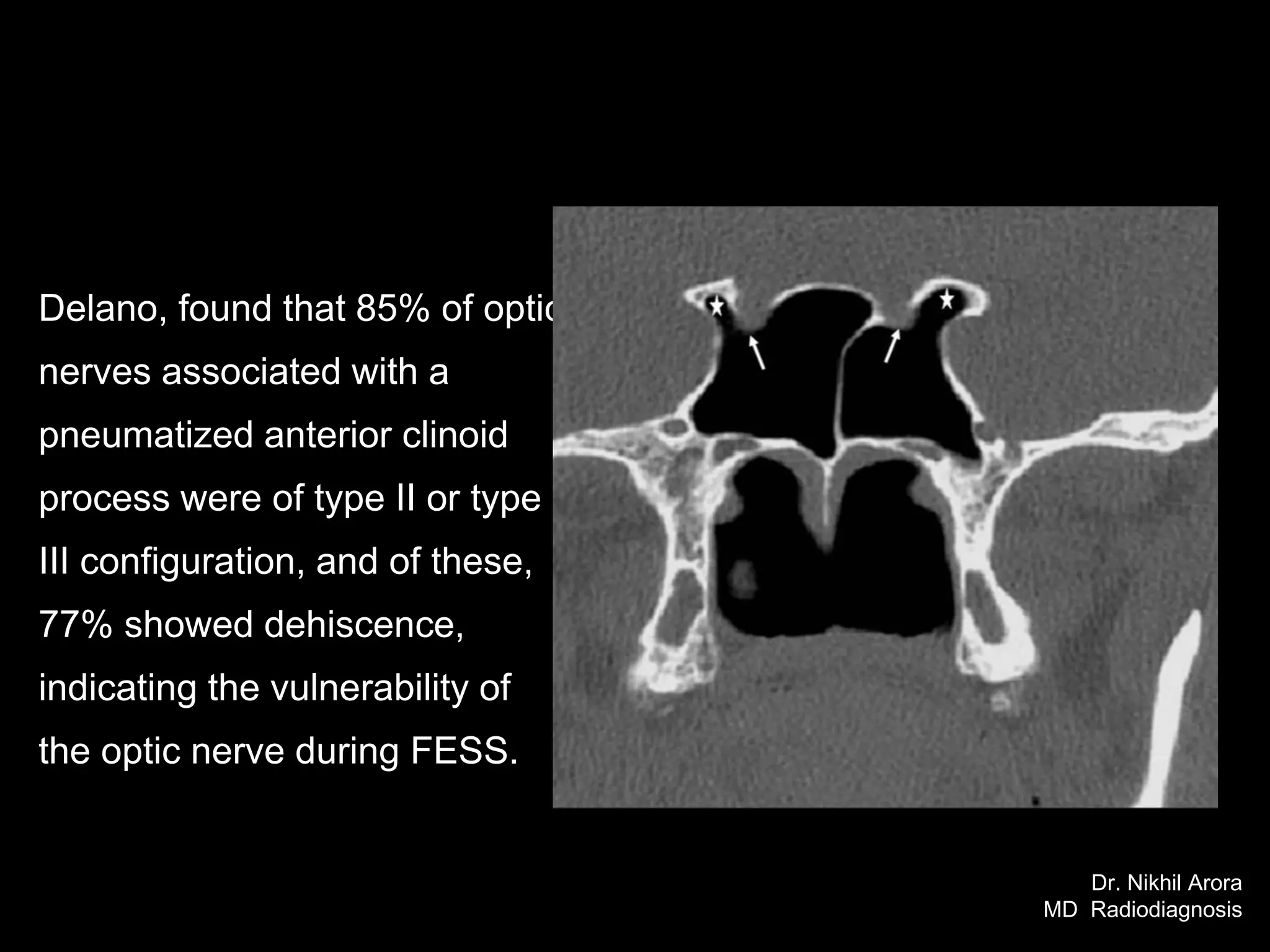 Paranasal sinuses .pptx