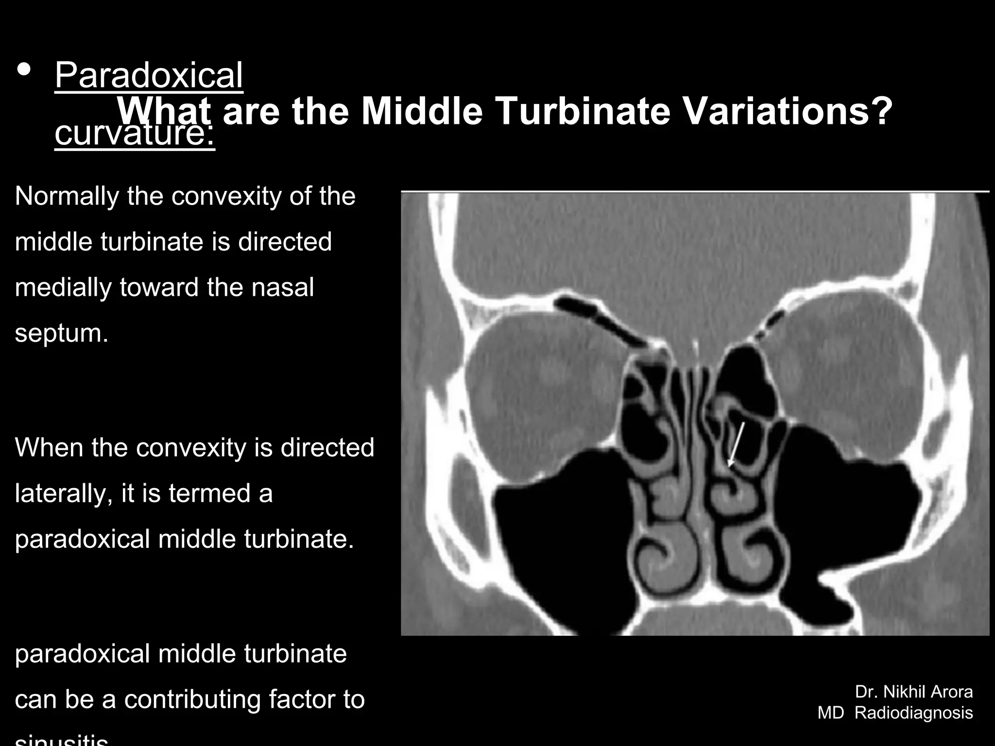 Paranasal sinuses .pptx