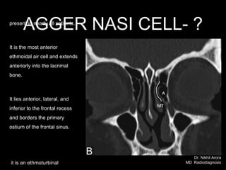 Paranasal sinuses .pptx