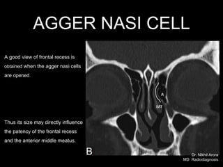 Paranasal sinuses .pptx