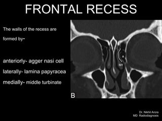 Paranasal sinuses .pptx