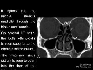 Paranasal sinuses .pptx