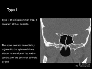 Paranasal sinuses .pptx
