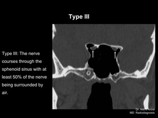 Paranasal sinuses .pptx