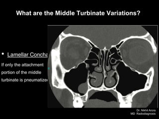 Paranasal sinuses .pptx