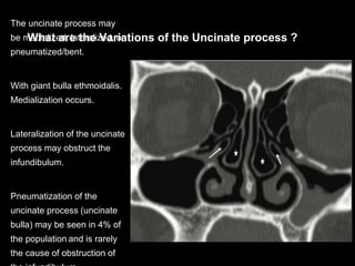 Paranasal sinuses .pptx