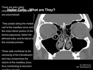 Paranasal sinuses .pptx