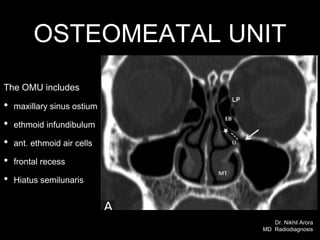 Paranasal sinuses .pptx