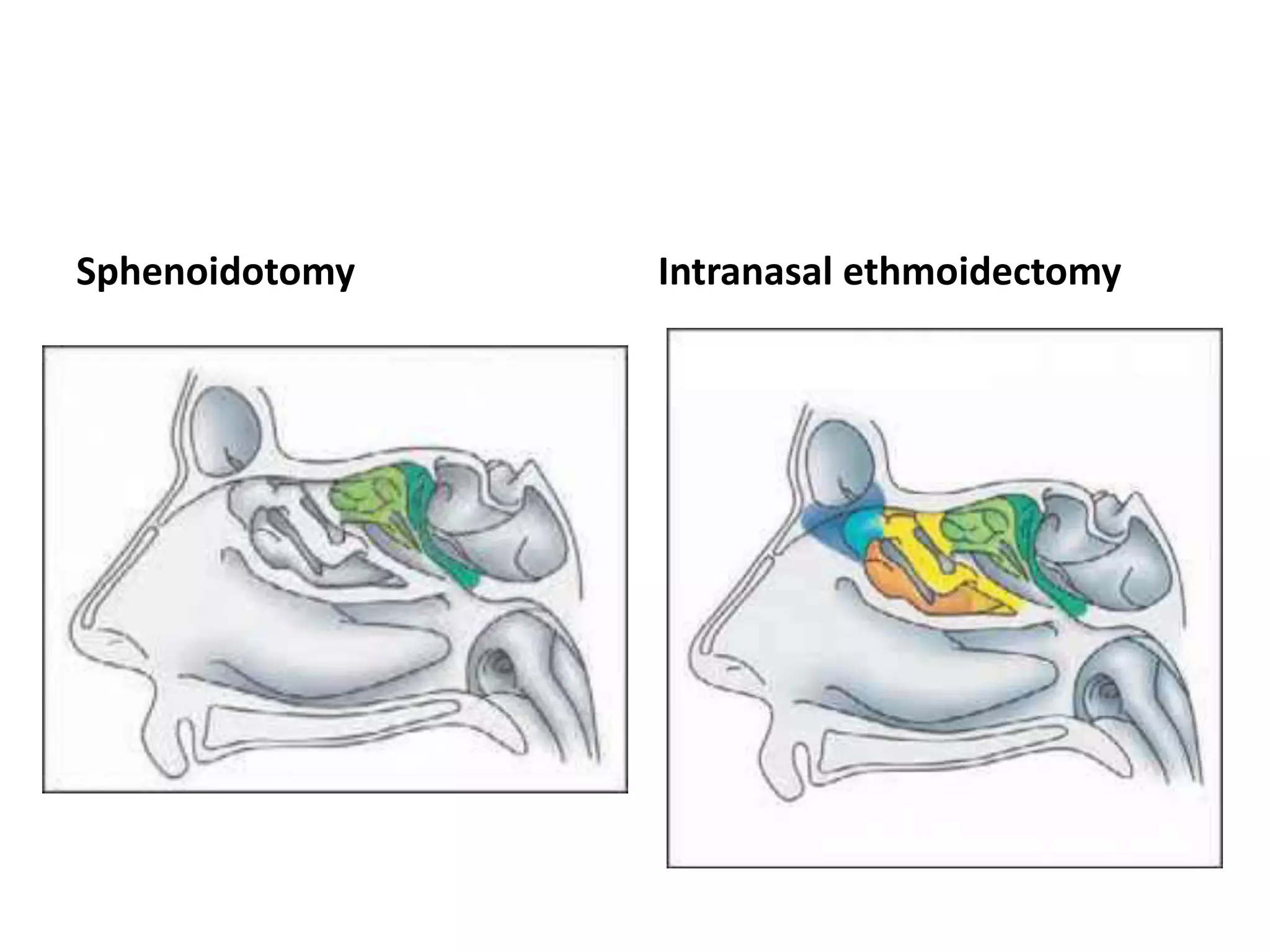 Paranasal sinuses | PDF