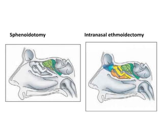 Paranasal sinuses | PDF