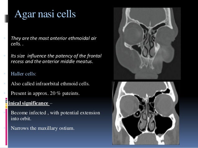 Paranasalsinuses