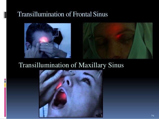 Paranasalsinuses