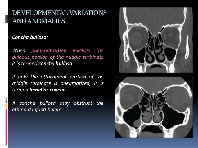 Paranasalsinuses