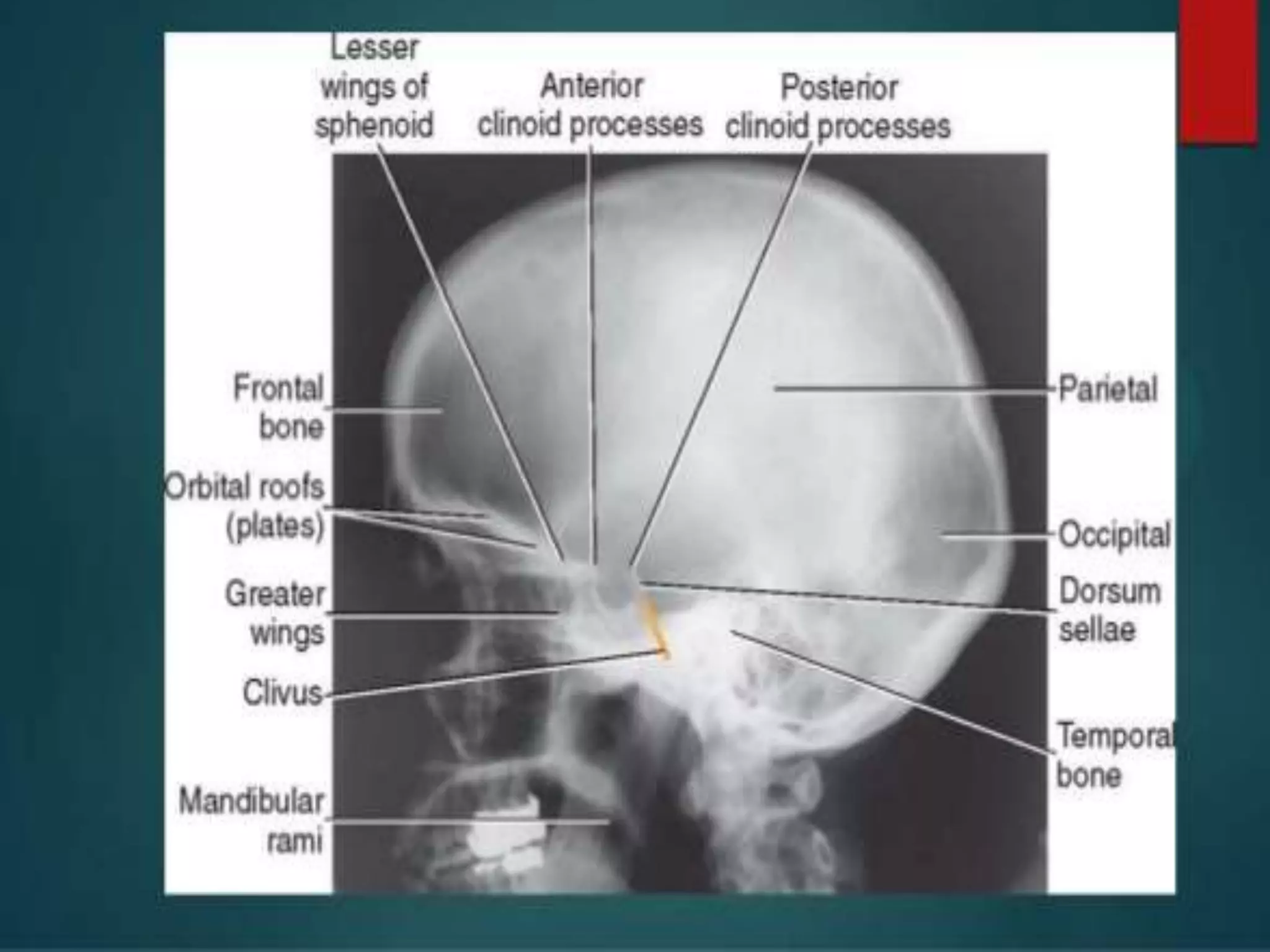 X-Ray skull & Paranasal sinuses | PPT
