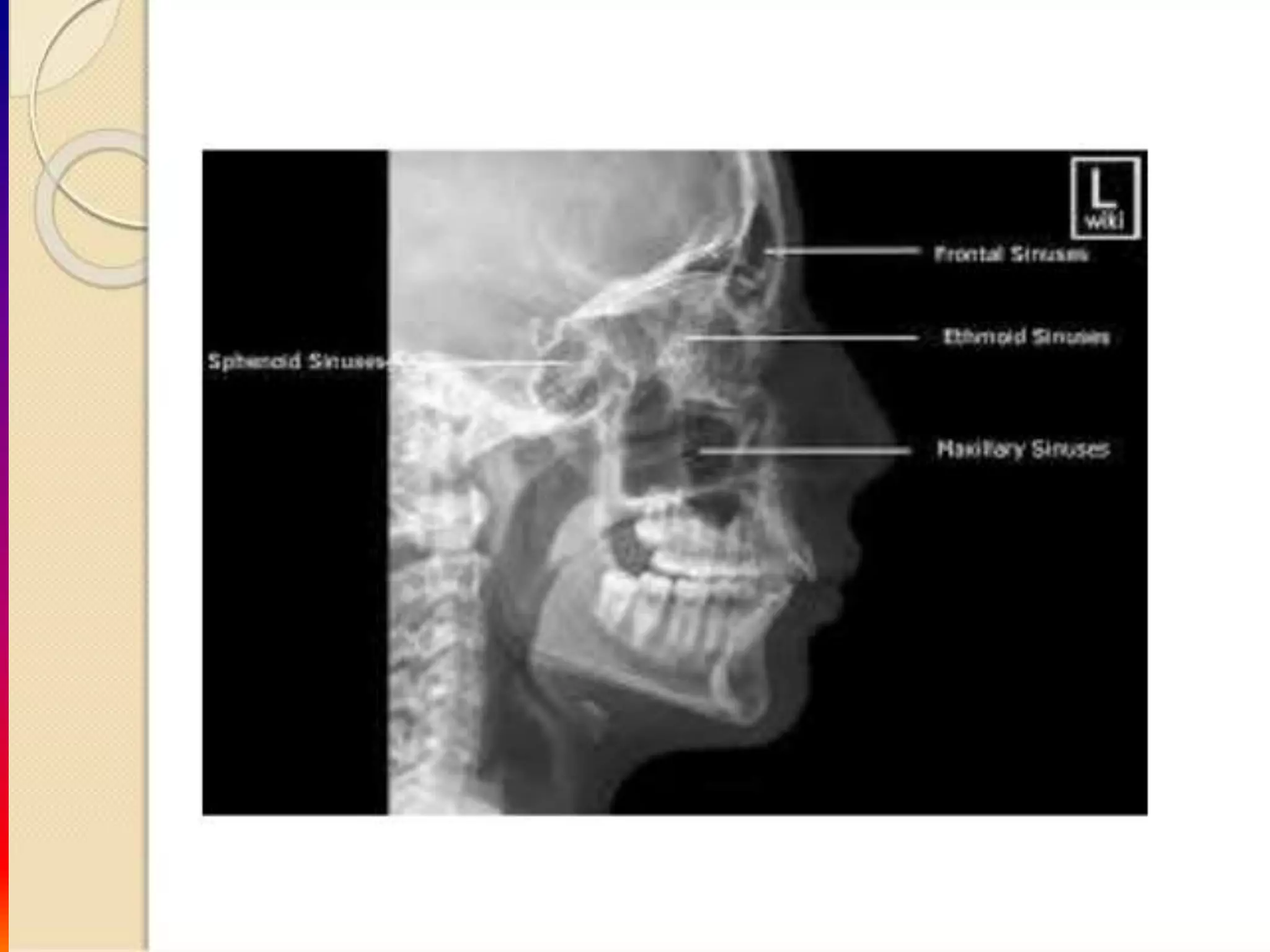X-Ray skull & Paranasal sinuses | PPT