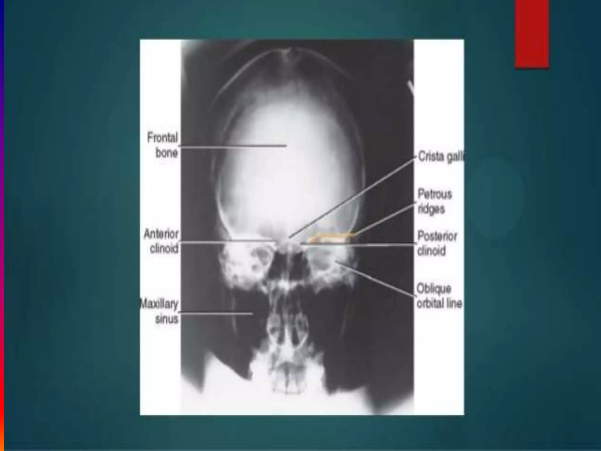 X-Ray skull & Paranasal sinuses | PPT