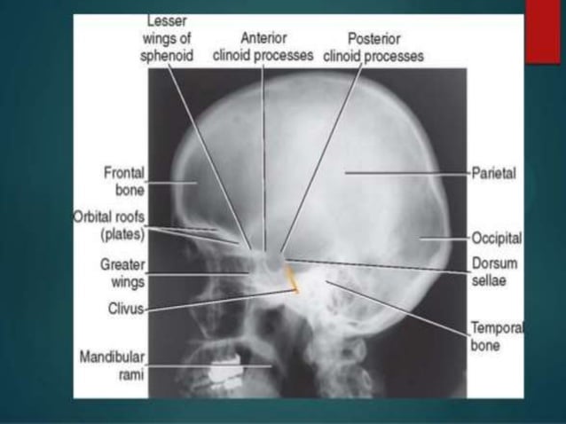X-Ray skull & Paranasal sinuses | PPTX