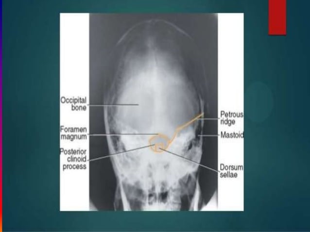 X-Ray skull & Paranasal sinuses | PPT
