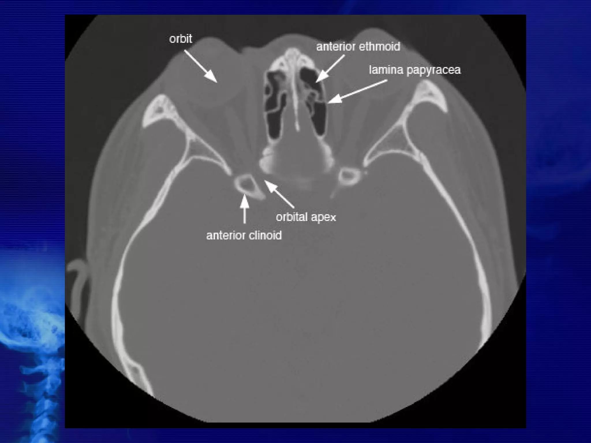 Paranasal sinuses anatomy and pathology dr ashok | PPT