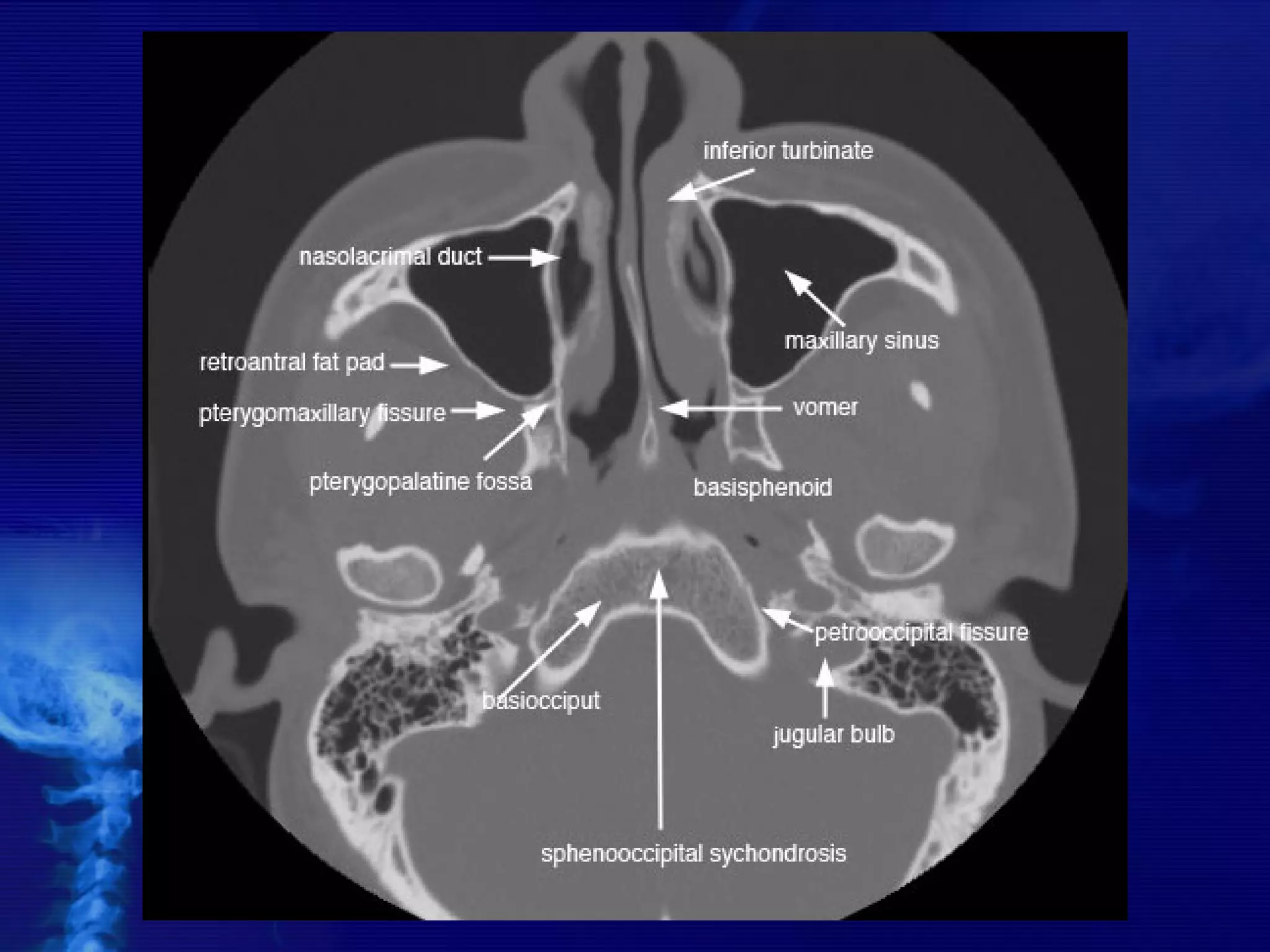 Paranasal sinuses anatomy and pathology dr ashok | PPT