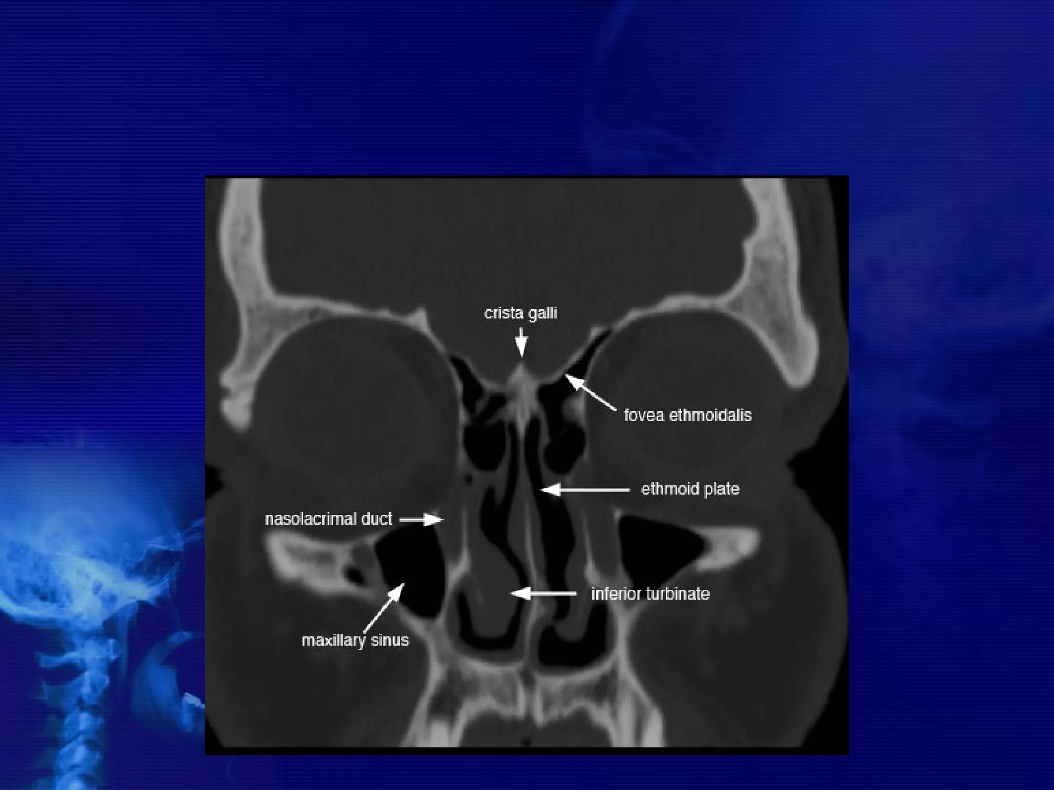 Paranasal sinuses anatomy and pathology dr ashok | PPT