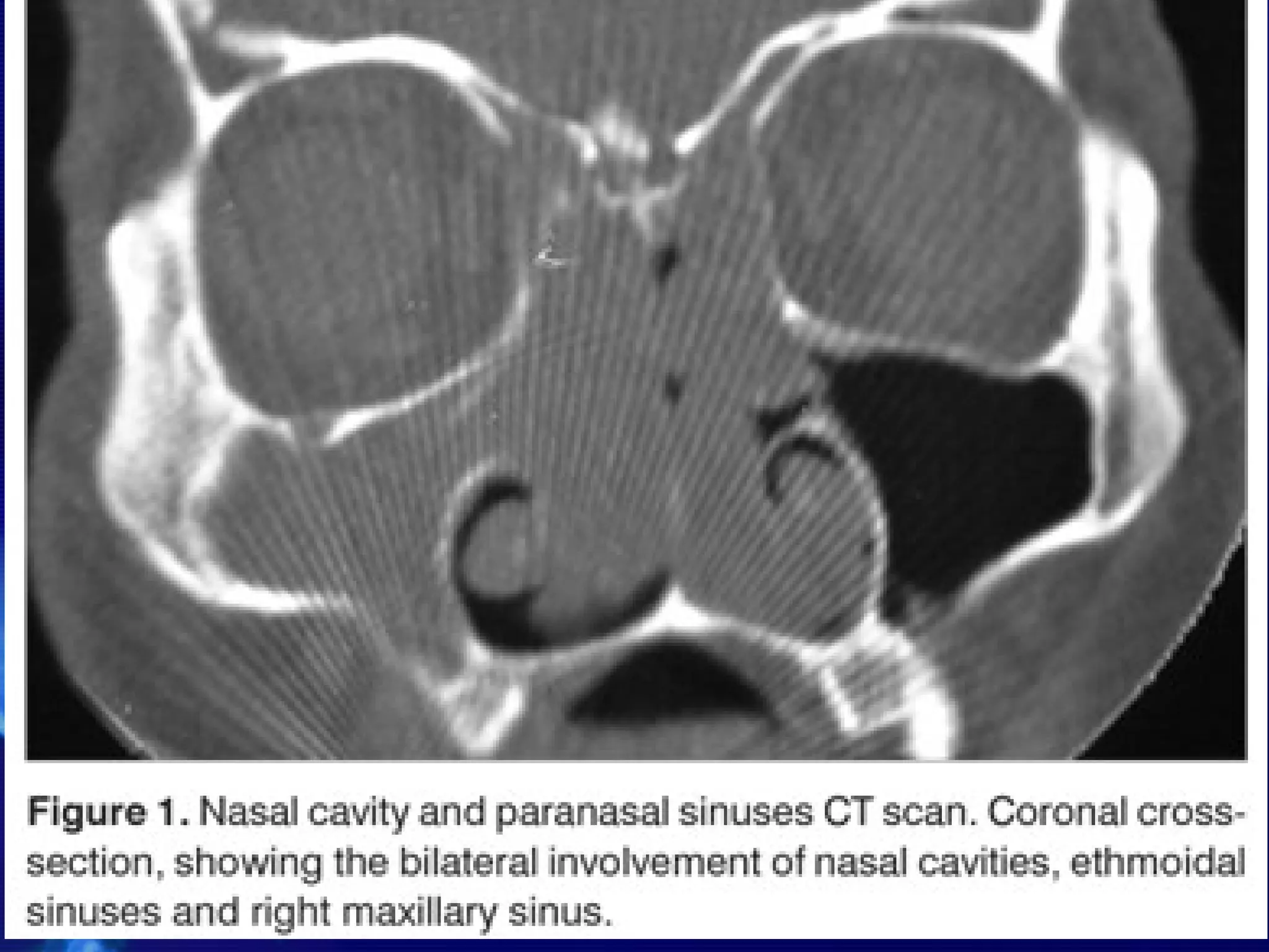 Paranasal sinuses anatomy and pathology dr ashok | PPT