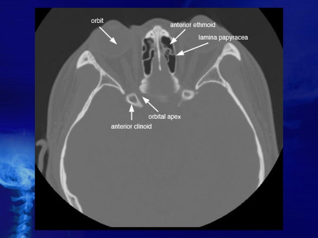 Paranasal sinuses anatomy and pathology dr ashok | PPT | Ear, Nose and ...