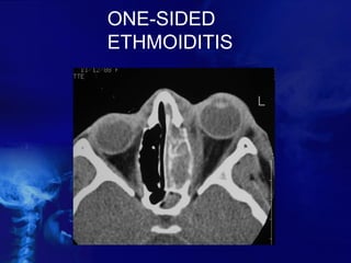 Paranasal sinuses anatomy and pathology dr ashok | PPT