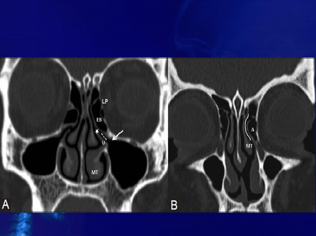 Paranasal sinuses anatomy and pathology dr ashok | PPT | Ear, Nose and ...