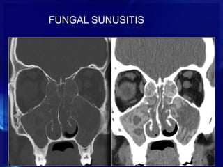 Paranasal sinuses anatomy and pathology dr ashok | PPT