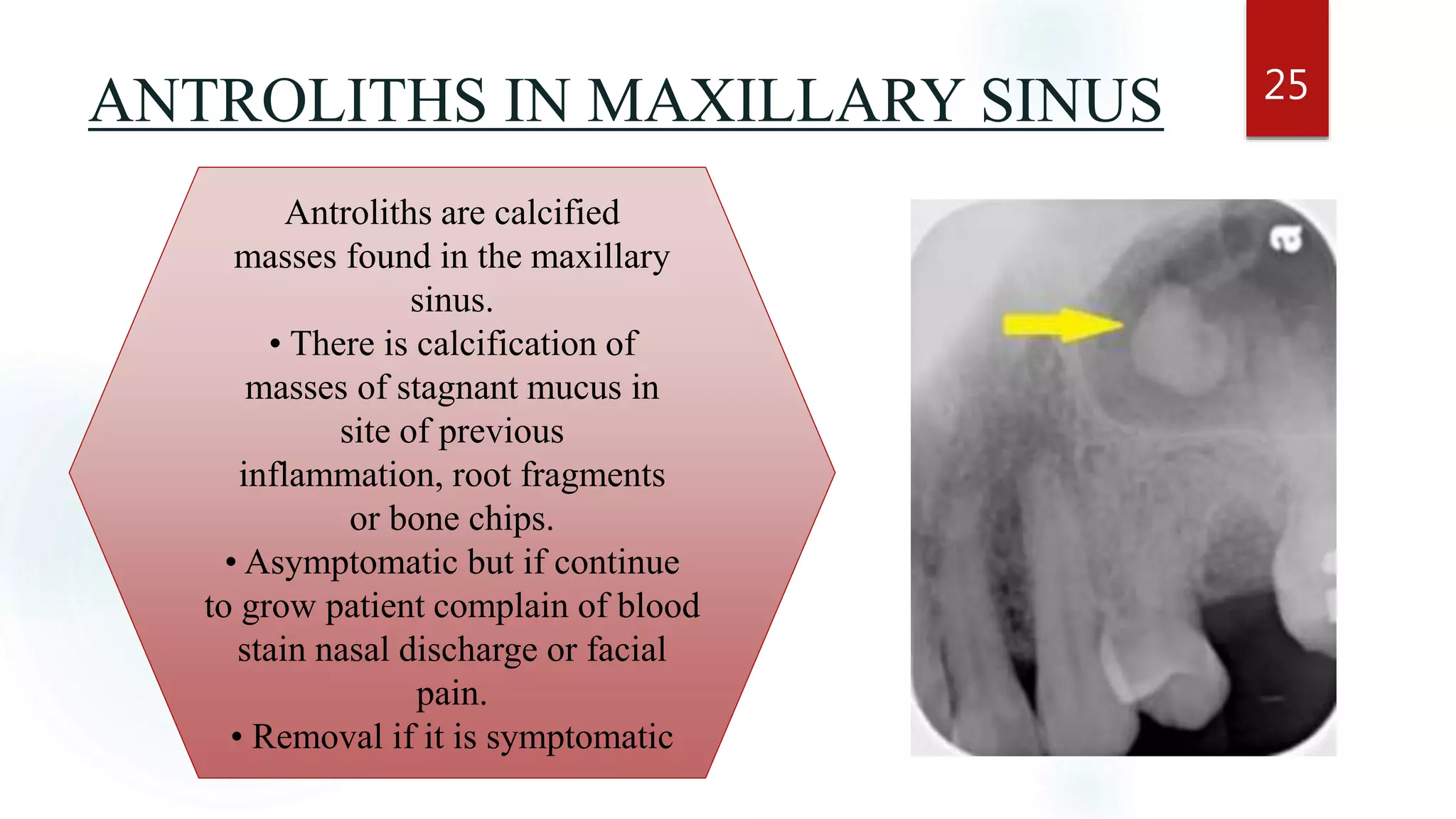 Paranasal sinuses | PPTX