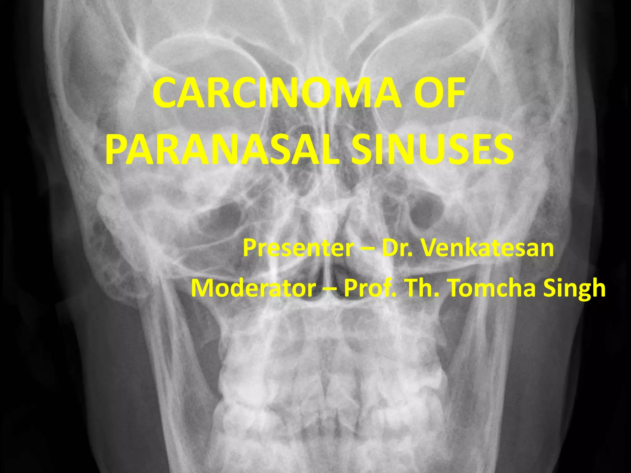 Paranasal sinuses carcinoma | PPTX