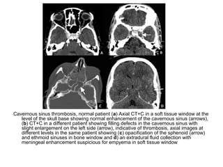 Diagnostic Imaging of Paranasal sinuses and Nose | PPT