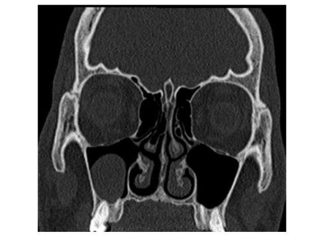 Diagnostic Imaging of Paranasal sinuses and Nose