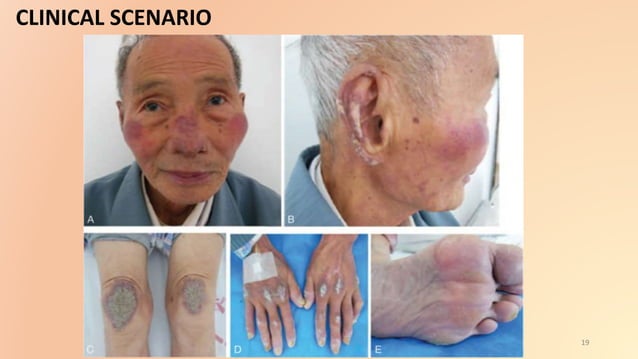 Paraneoplastic dermatoses | PPTX