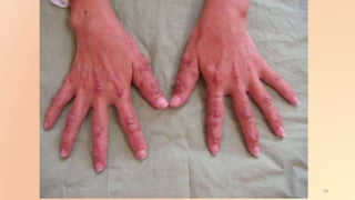 Paraneoplastic dermatoses | PPTX
