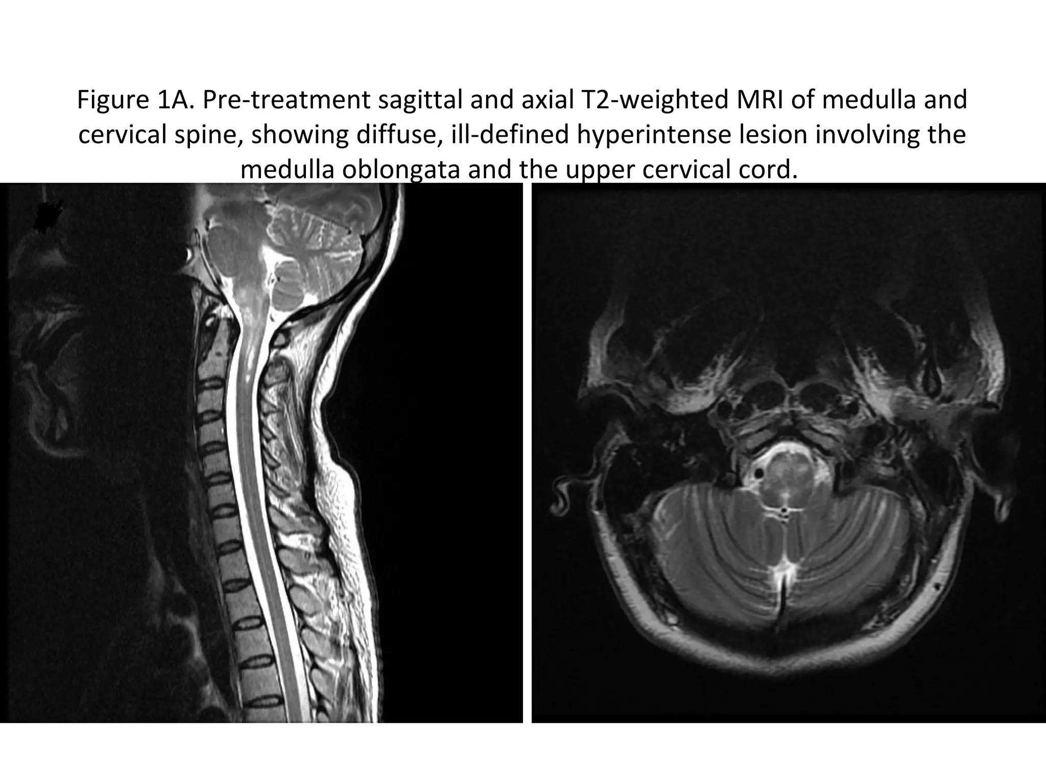 Paraneoplastic neuromyelitis optica associated with gastric carcinoid ...