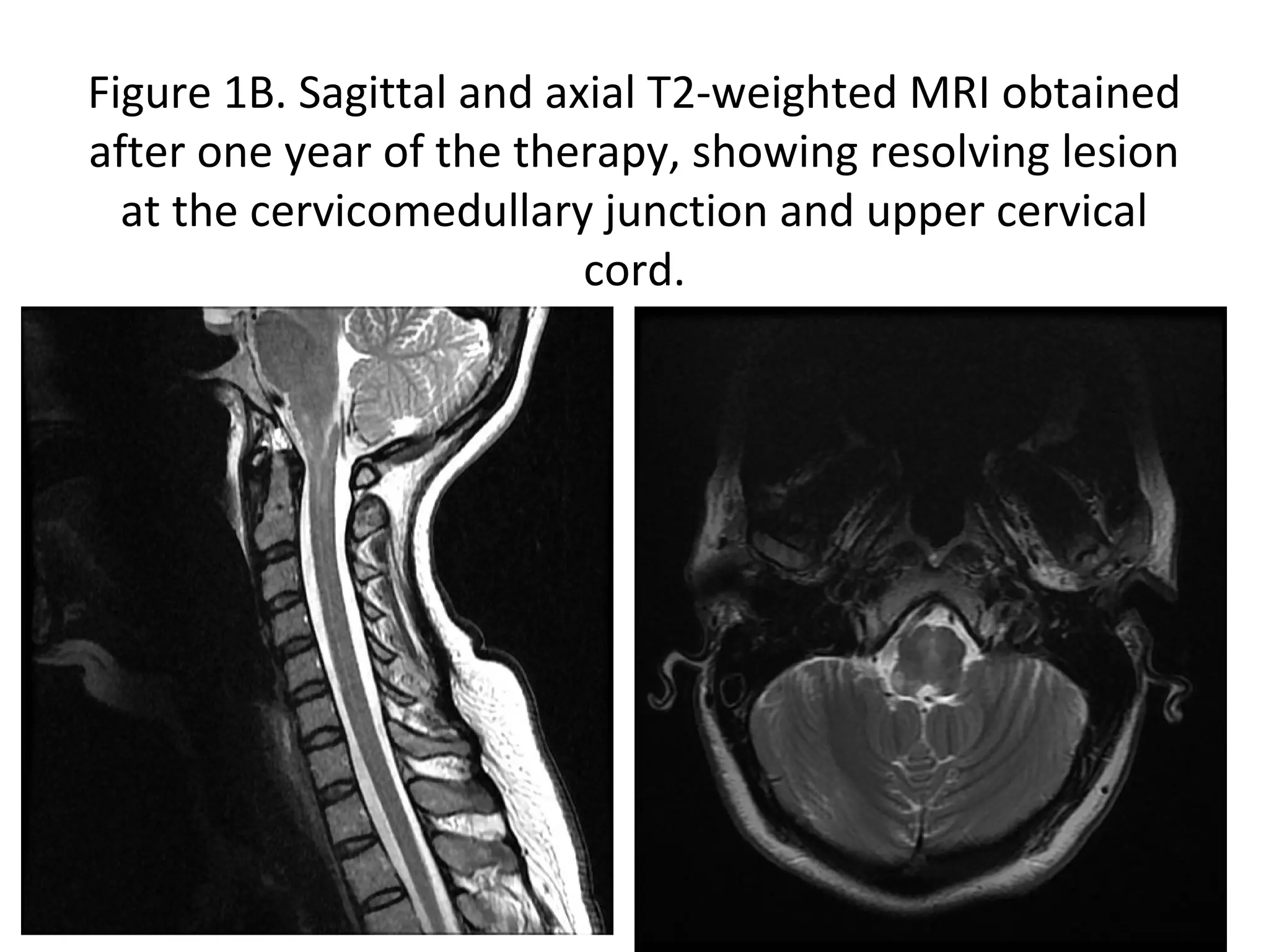 Paraneoplastic neuromyelitis optica associated with gastric carcinoid ...